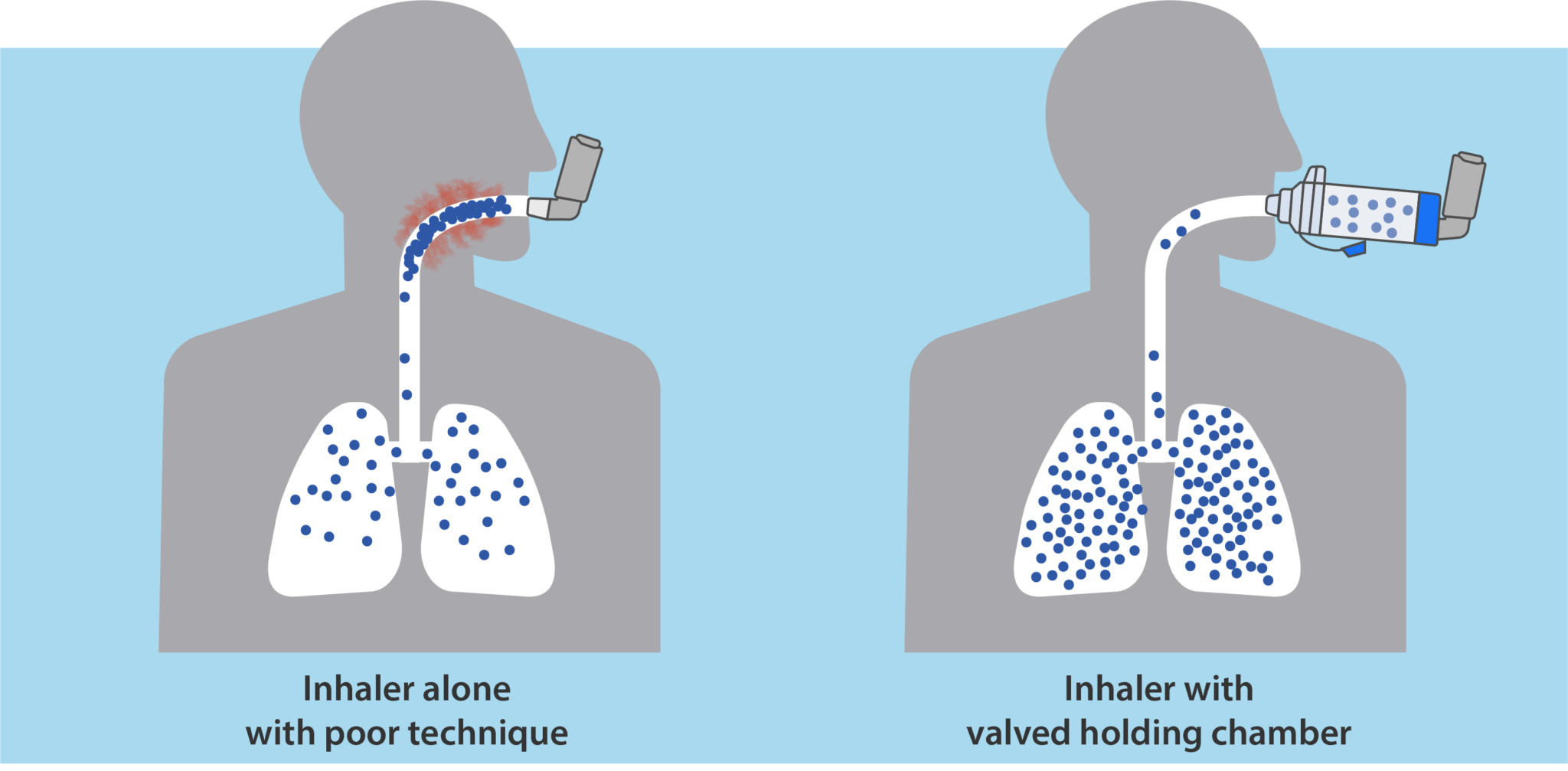 Conserving Albuterol During Shortage » Monaghan Medical